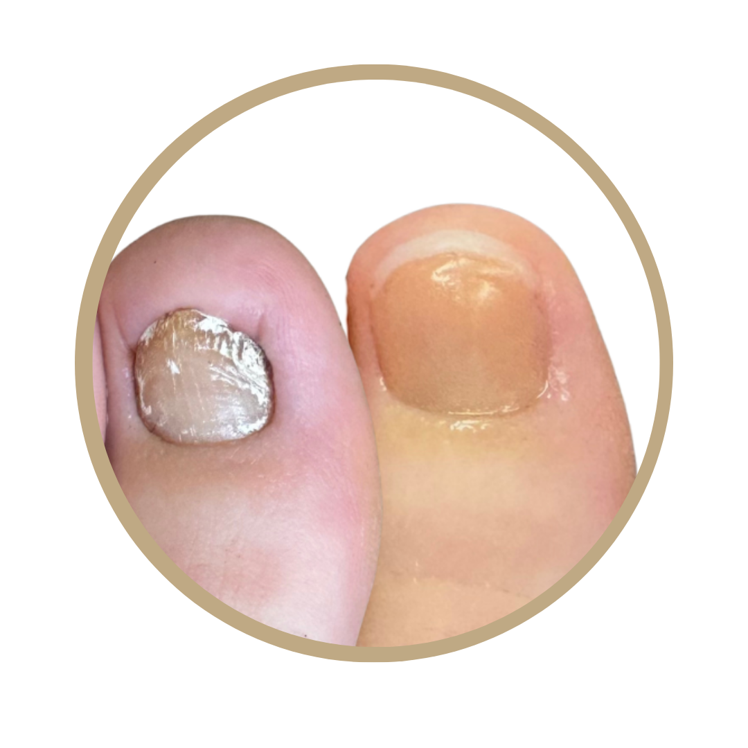 NEC - NAIL RECONSTRUCTION – Ancaster Foot Fixer and Orthotics Clinic